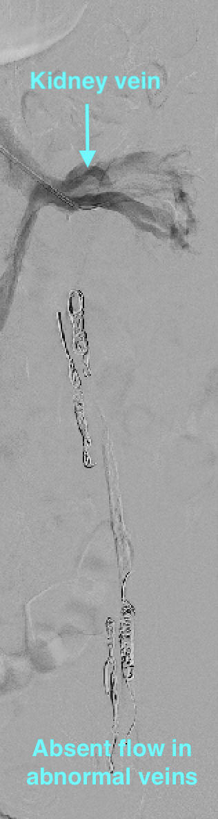 Scrotal Varicocele Infertility Gonadal Vein Embolization